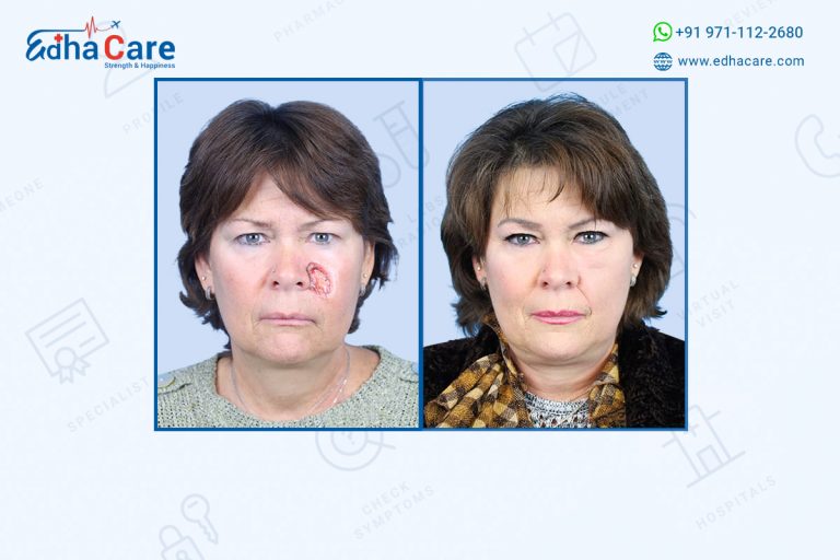 Meilleure chirurgie plastique et esthétique en Inde | EdhaCare