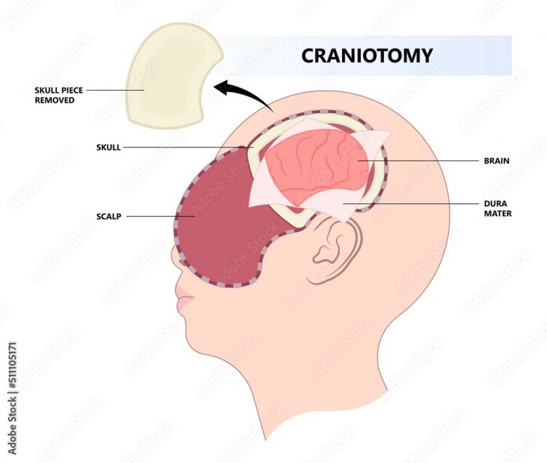 Best Brain Tumor Surgery In India | Expert Care & Options