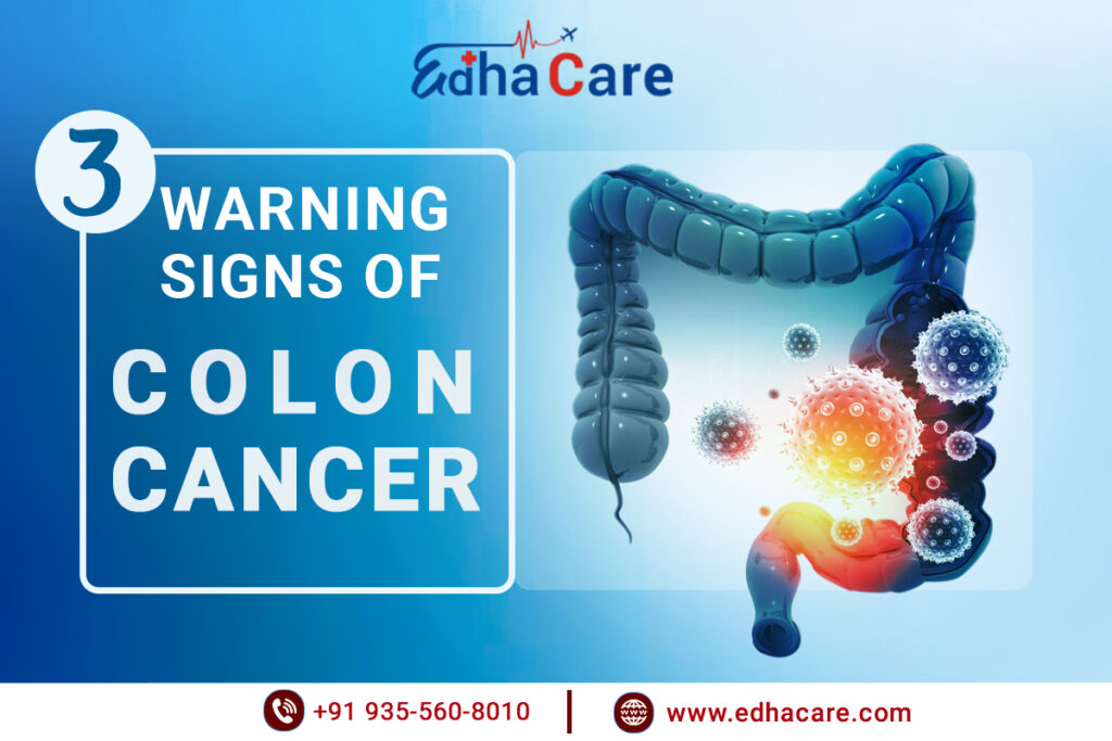 3 señales de advertencia del cáncer de colon: una guía de EdhaCare