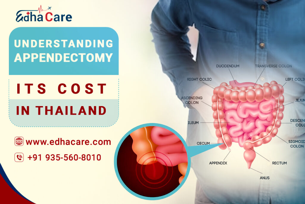 Costo de la apendicectomía en Tailandia: factores y conocimientos ...