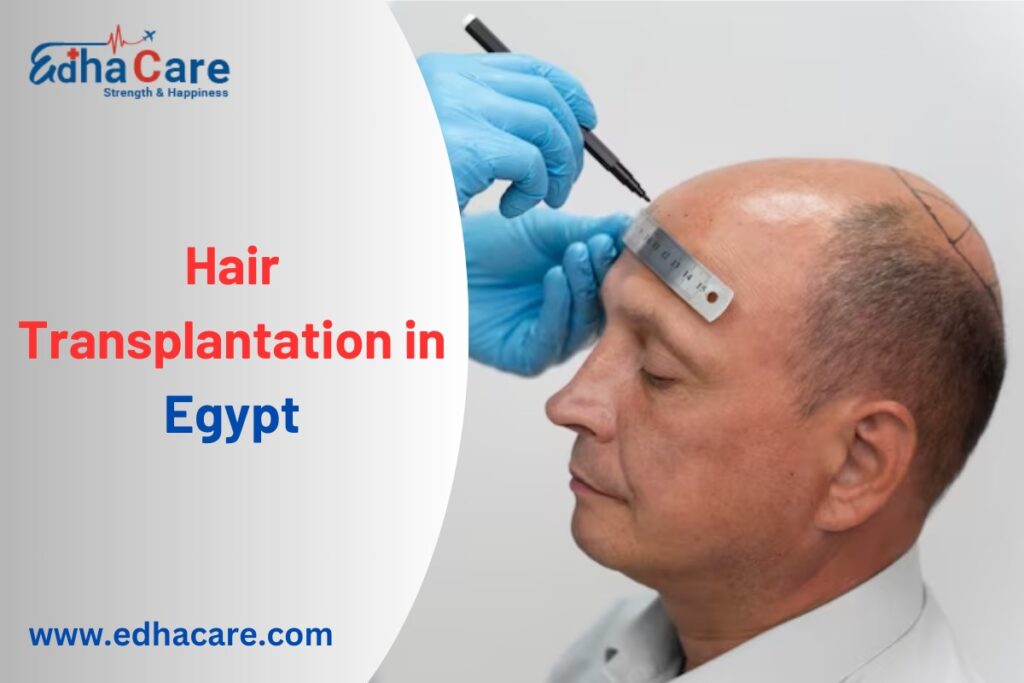 Trasplante de cabello en Egipto - Póngase en contacto con EdhaCare