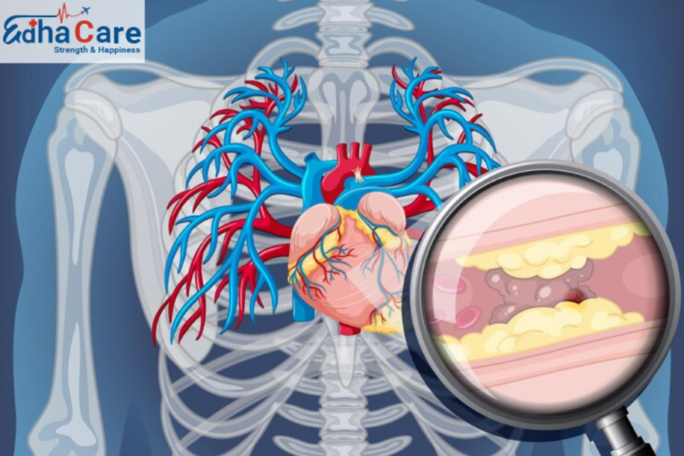 Symptômes du pont myocardique : signes et diagnostic