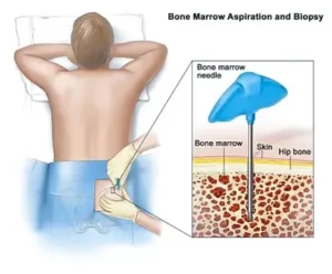 Bone Marrow Transplant Cost in Dubai | EdhaCare