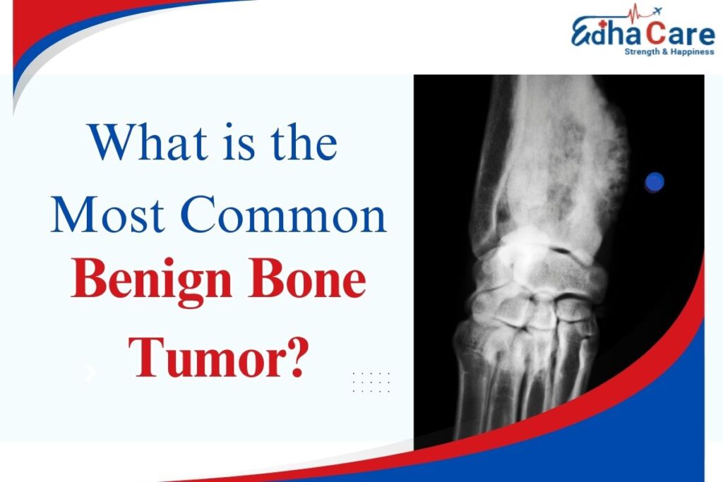 Most Common Benign Bone Tumor | Edhacare