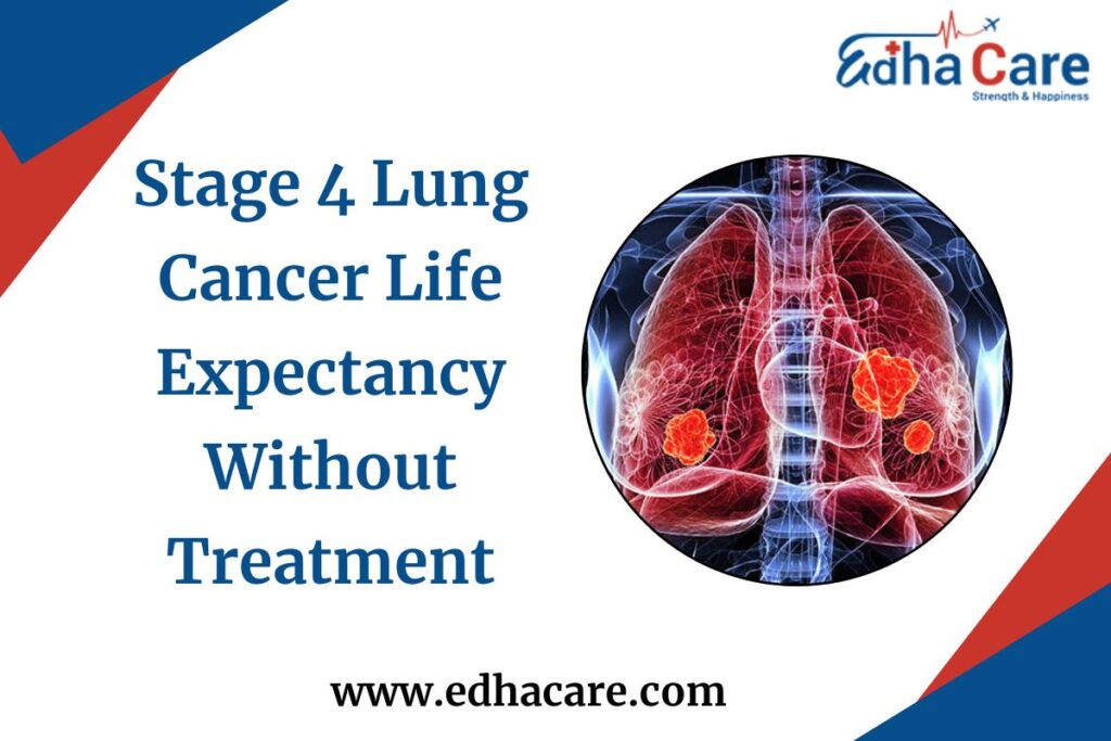 Stage 4 Lung Cancer Life Expectancy Without Treatment: What You Need to ...