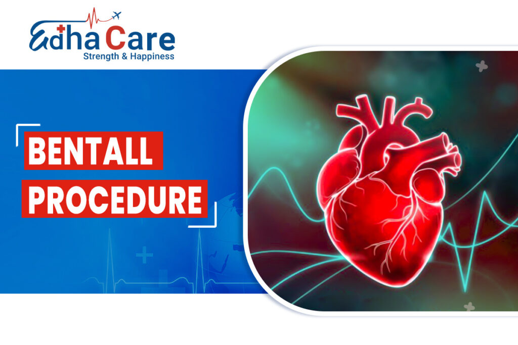 Bentall-procedure | Indikationer, typer, risici og helbredelse