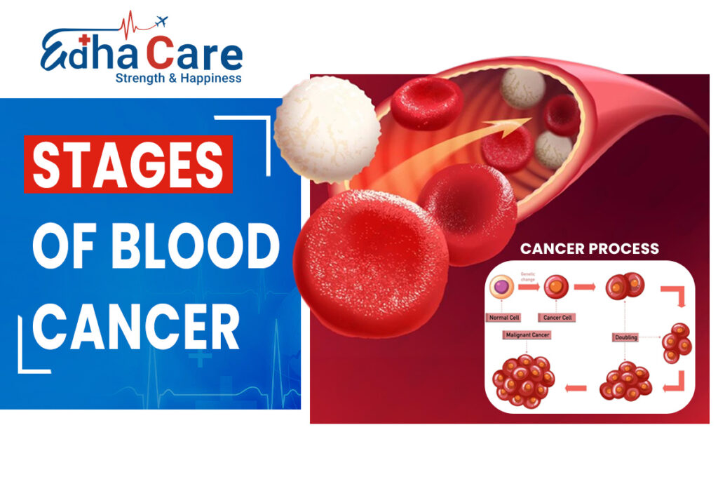 Cilat janë fazat e ndryshme të kancerit të gjakut?
