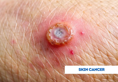 Skin Cancer Treatment - Procedure, Doctors, Cost | India