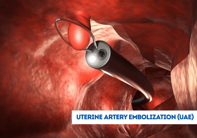 Uterine Artery Embolization (UAE) - Diagnosis And Treatment | EdhaCare