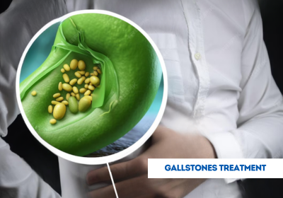 Rawatan Batu Hempedu | Batu hempedu | Gastroenterologi | EdhaCare