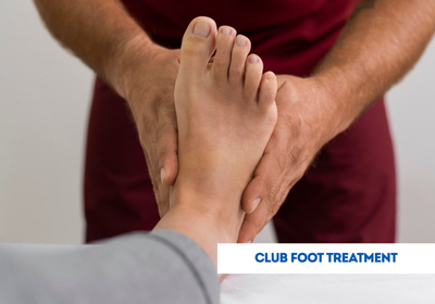 Club Foot Treatment: Symptoms, Treatment Cost | India