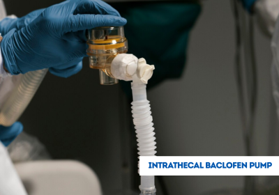 Intrathecal Baclofen Pump | Baclofen Pump Surgery Recovery Time | EdhaCare