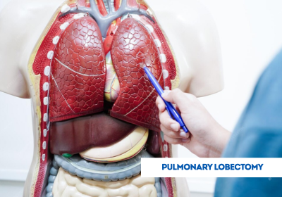 Lobectomía pulmonar en India | Causas, síntomas y tratamiento