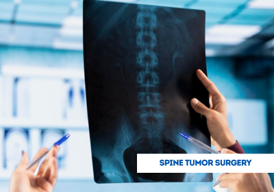 Vertebroplasty Surgery: - Causes & Treatment Procedure